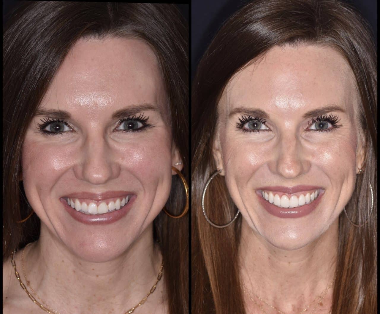 Cosmetic Dentist in Ridgeland MS - Murphey Dental Aesthetics